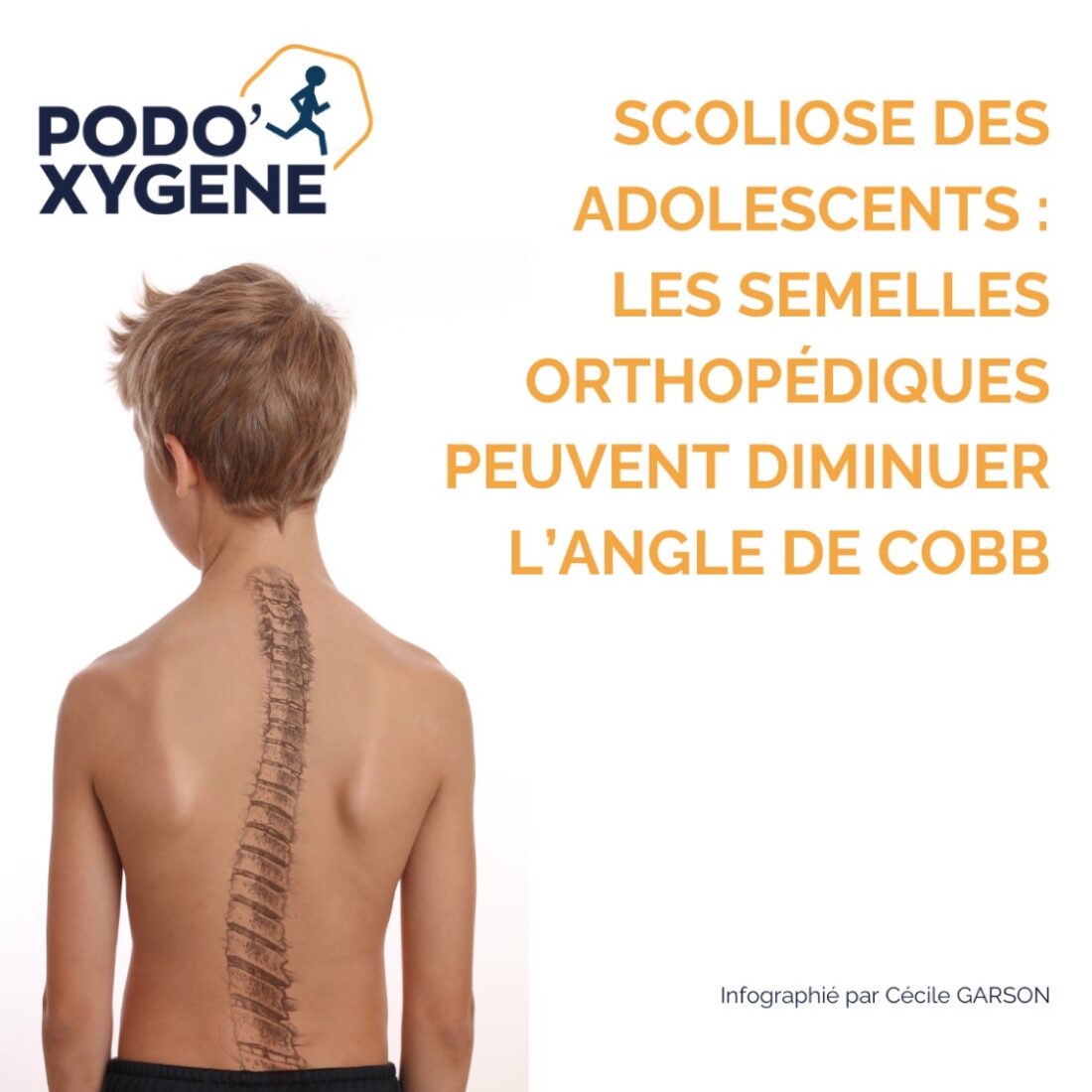 Scoliose des adolescents: Les semelles orthopédiques peuvent diminuer l ...